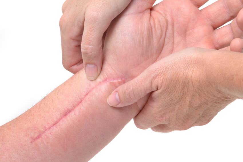 Different Types Of Scars And Scar Treatment Options